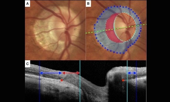 Glaucoma Research Group - Dalhousie University