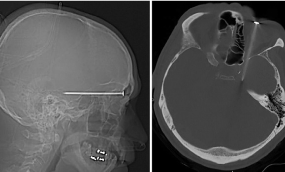 Complete recovery following transorbital penetrating head injury ...