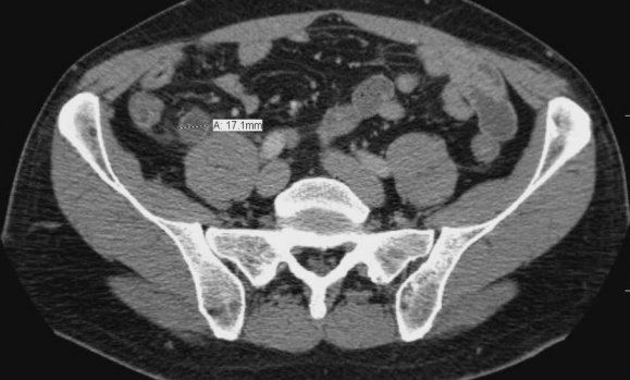 Diagnostic Performance And Radiation Dose Of Reduced Vs Standard Scan