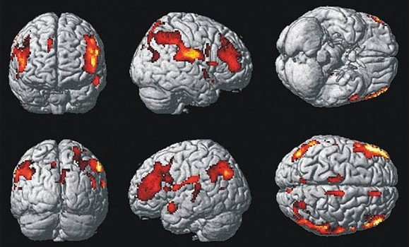 Insights into schizophrenia - Dal News - Dalhousie University