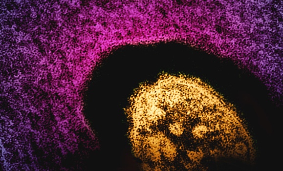 Ask an expert: Why are we seeing measles outbreaks across Canada and ...